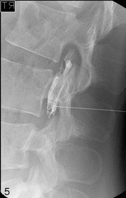 Spinal Injections | Mountain View Rehabilitation Medical Associates